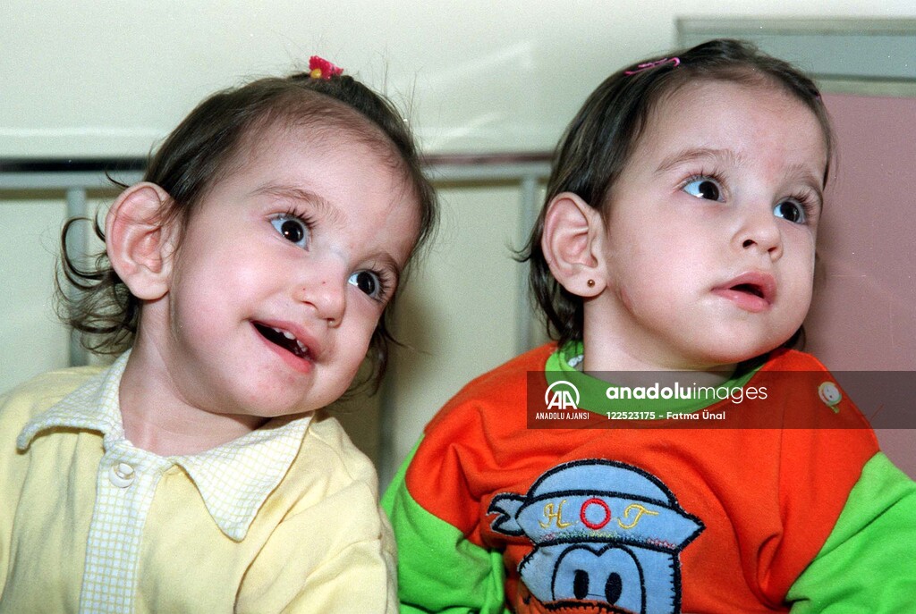 AMELIYATLA AYRILAN YAPISIK IKIZLER | Anadolu Images